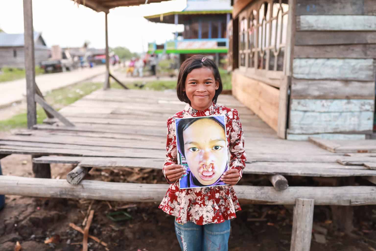 Cleft Lip and Palate: Causes, Symptoms and Treatments - Mummy Matters ...