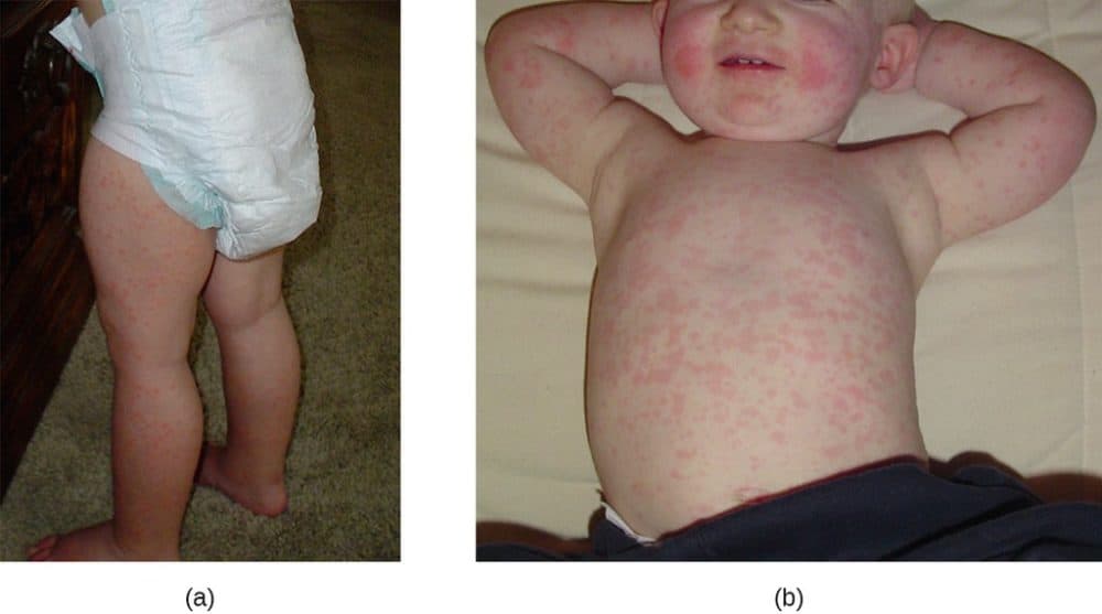 4 Frequently Seen Baby Rashes And How To Treat Them