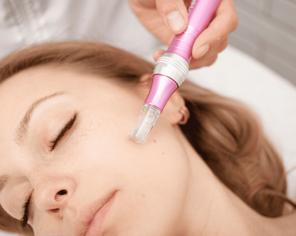 A Comprehensive Guide To Preparation And Procedure For Microneedling